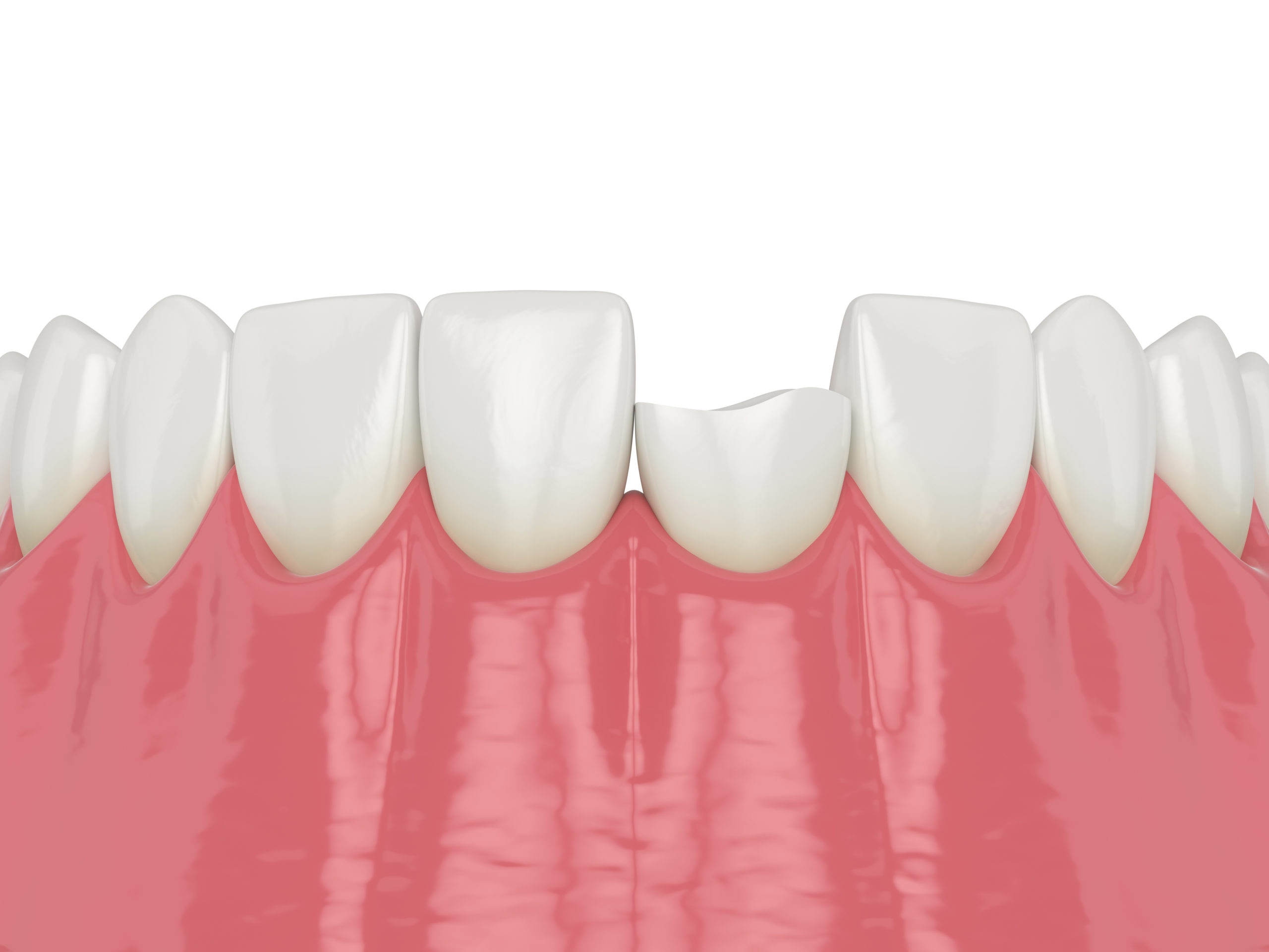 When Do You Need to Get a Dental Crown? | Gold Coast